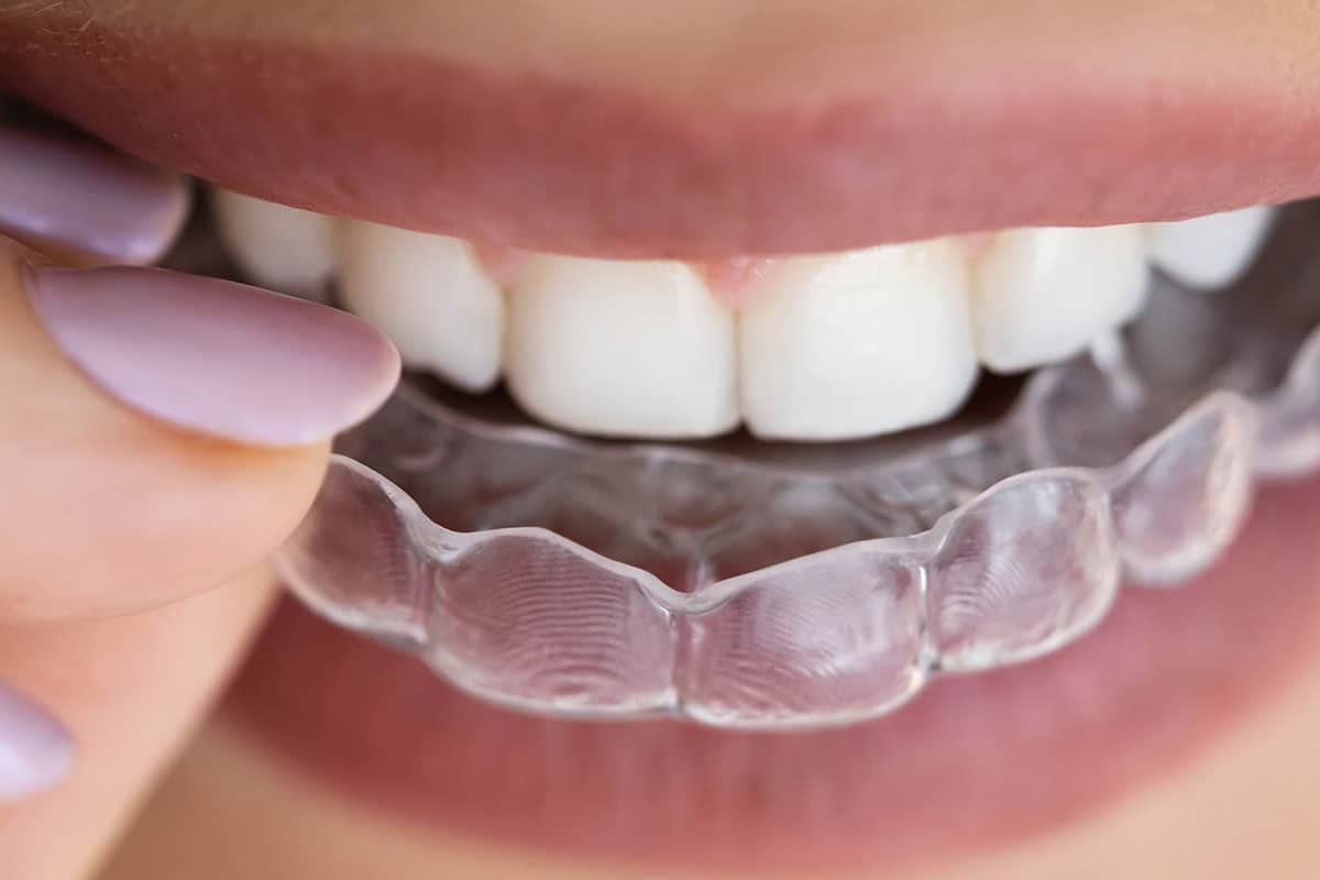 The Journey to Perfect Teeth Alignment: Get a Perfect Smile